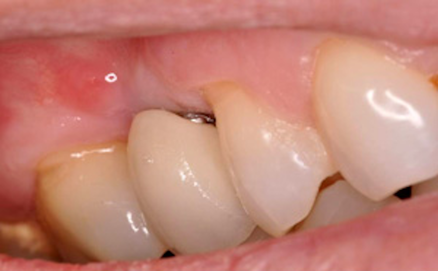 The implant dilemma | Registered Dental Hygienist (RDH) Magazine