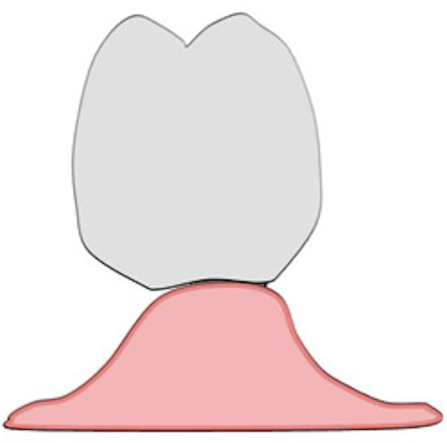 The implant dilemma | Registered Dental Hygienist