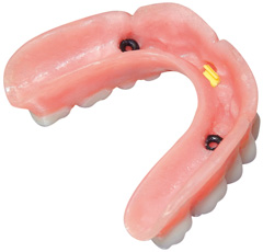 Focus on implant home care | Registered Dental Hygienists