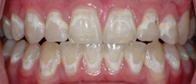 Your role before, during, and after orthodontic treatment | Registered ...