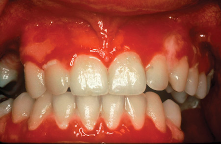 Oral Pemphigus and Pemphigoid: Why are these conditions so hard to ...