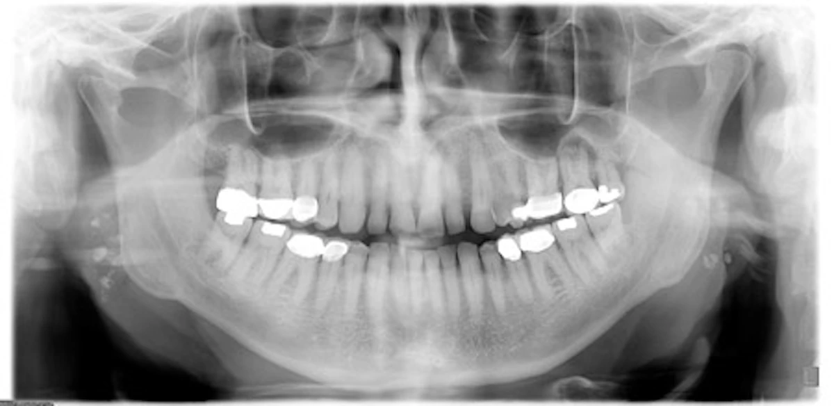 Tonsilloliths: Opacities on panoramic images | Registered Dental ...