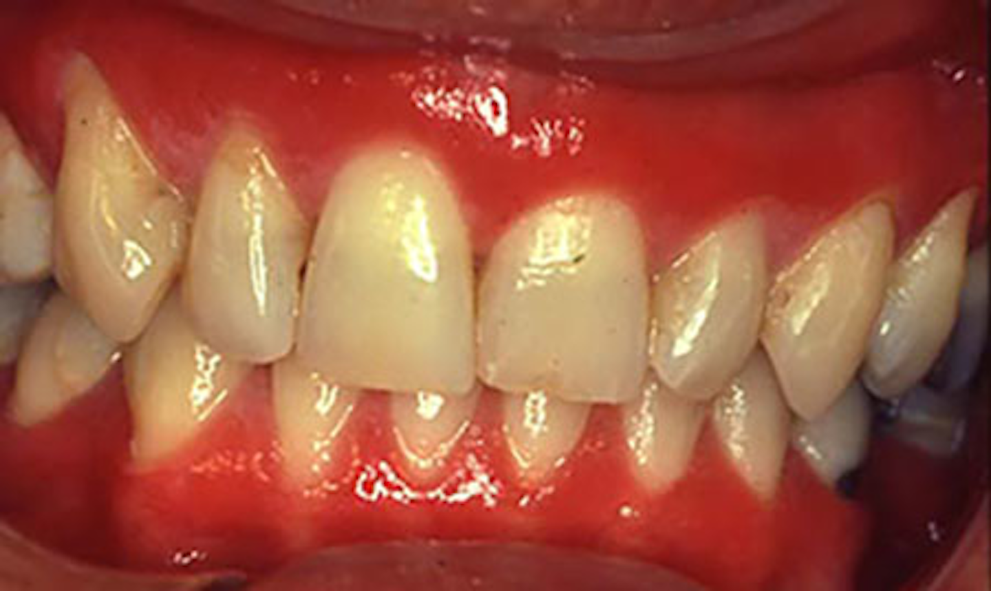 Plasma Cell Gingivitis: Investigate products that cause gingival ...