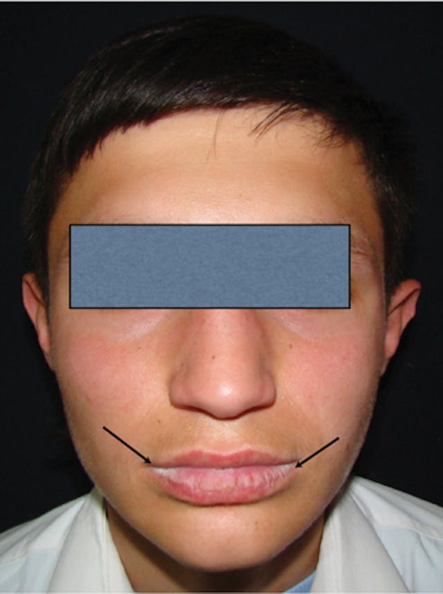 White sponge nevus | Registered Dental Hygienists