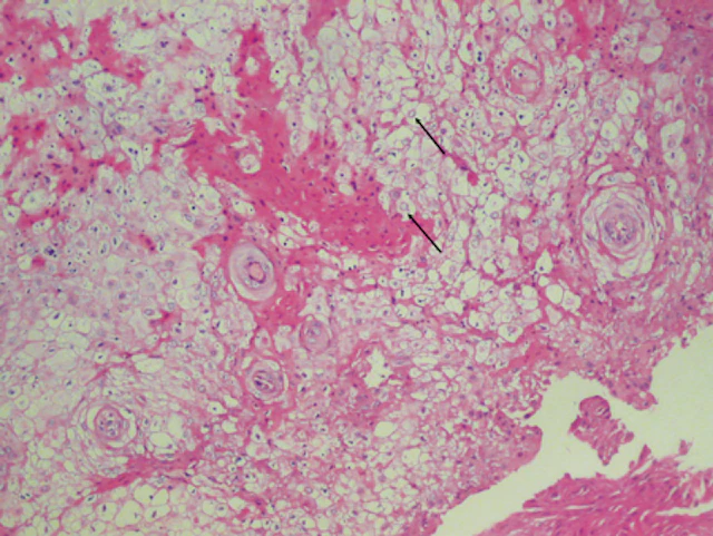 White sponge nevus | Registered Dental Hygenist (RDH) Magazine