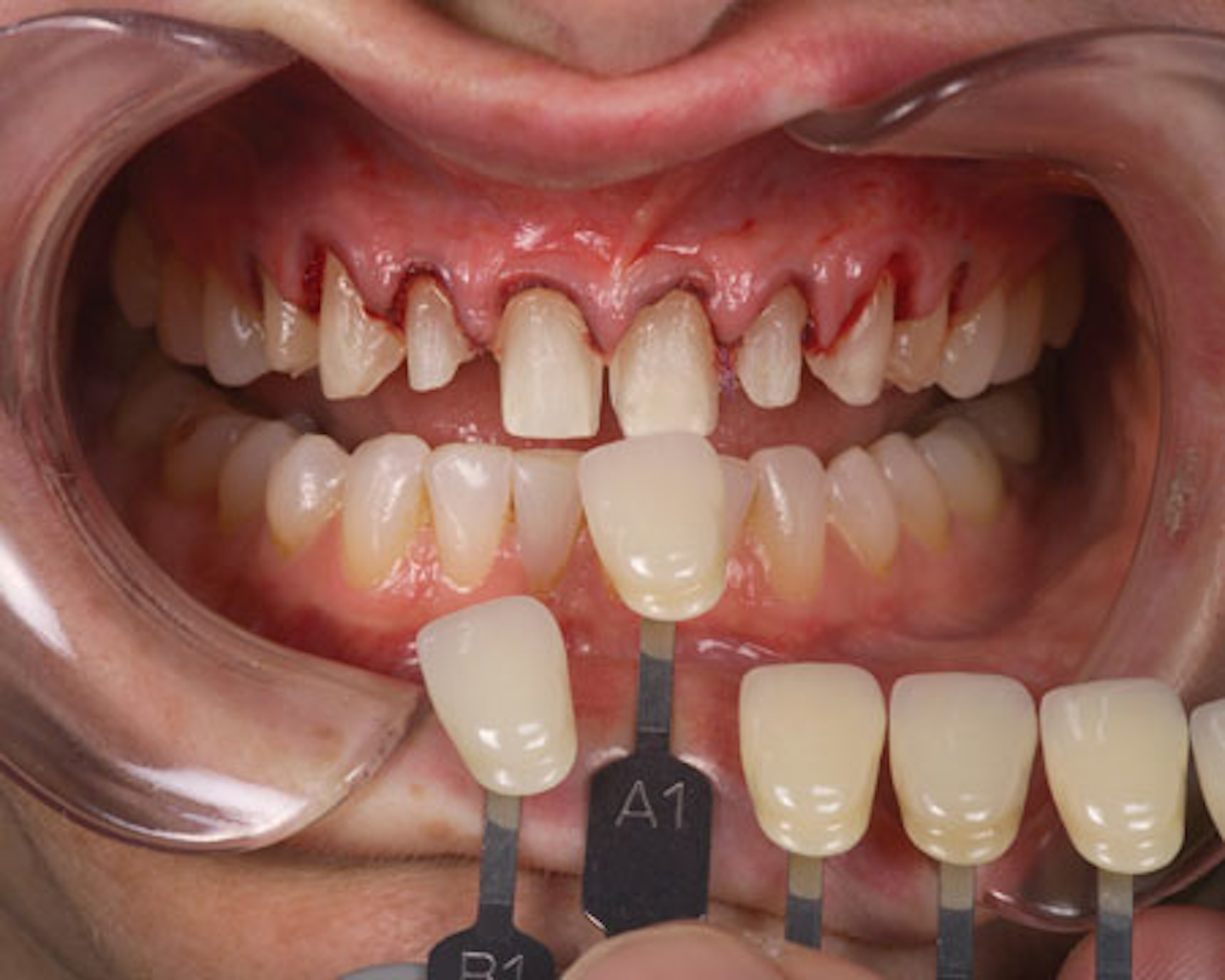 Another tool to help reduce gingivitis: Toothpaste encourages gingival ...