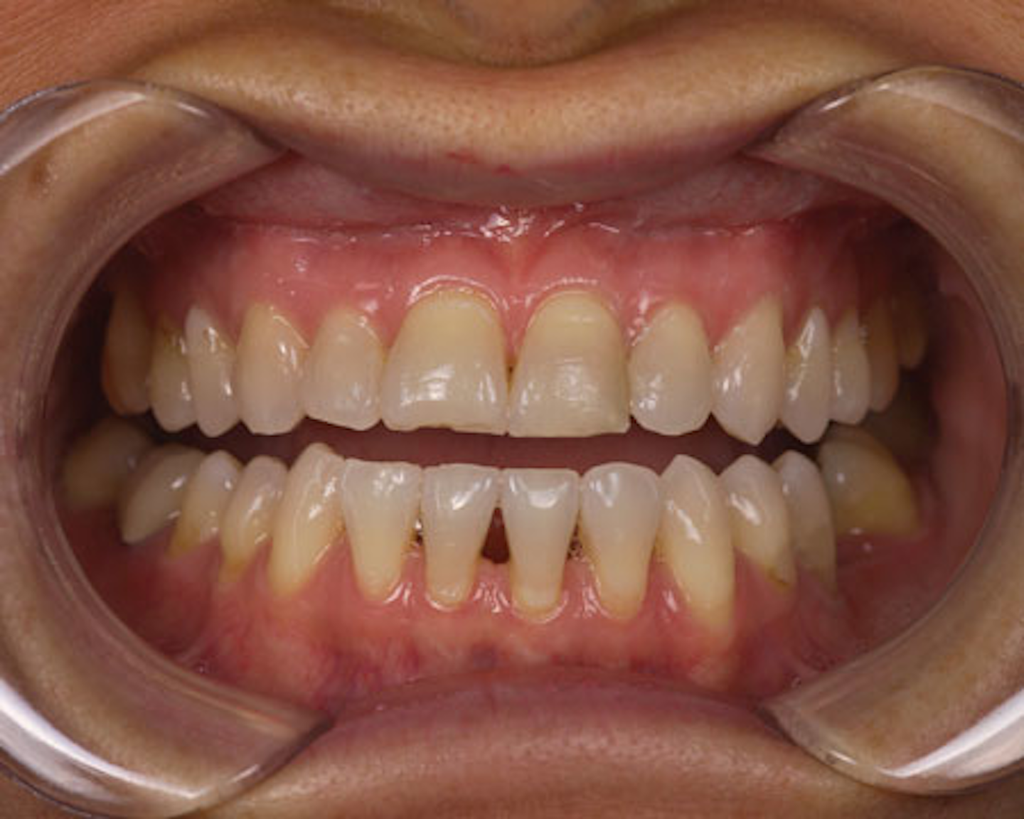 Another tool to help reduce gingivitis: Toothpaste encourages gingival ...