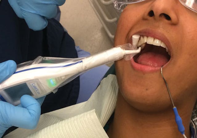 Understanding caries detection devices: Technology assists minimally ...