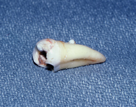 The elusive enamel pearl | Registered Dental Hygienists