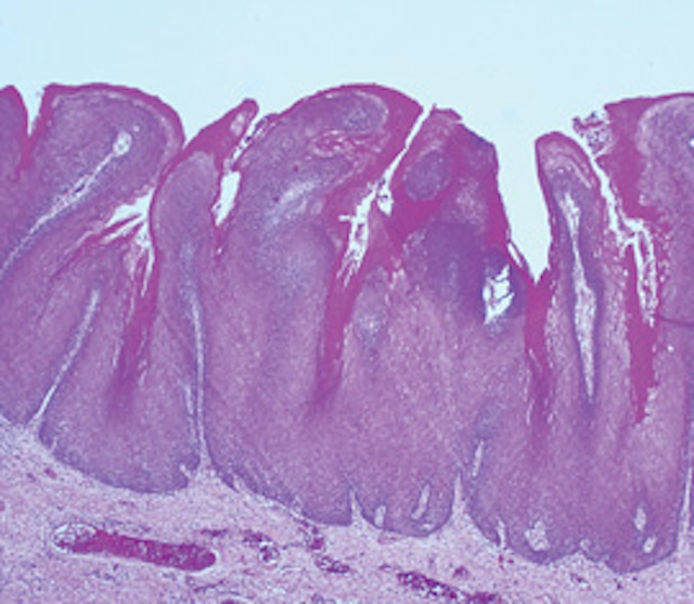 Verrucous Carcinoma | Registered Dental Hygienist