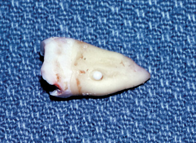 The elusive enamel pearl | Registered Dental Hygienist