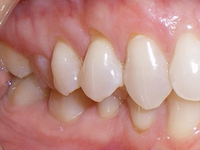 Oral Health Solutions with Clear Aligner Therapy: Three case studies ...