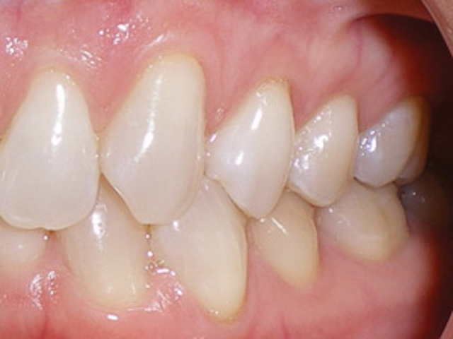 Oral Health Solutions with Clear Aligner Therapy: Three case studies ...