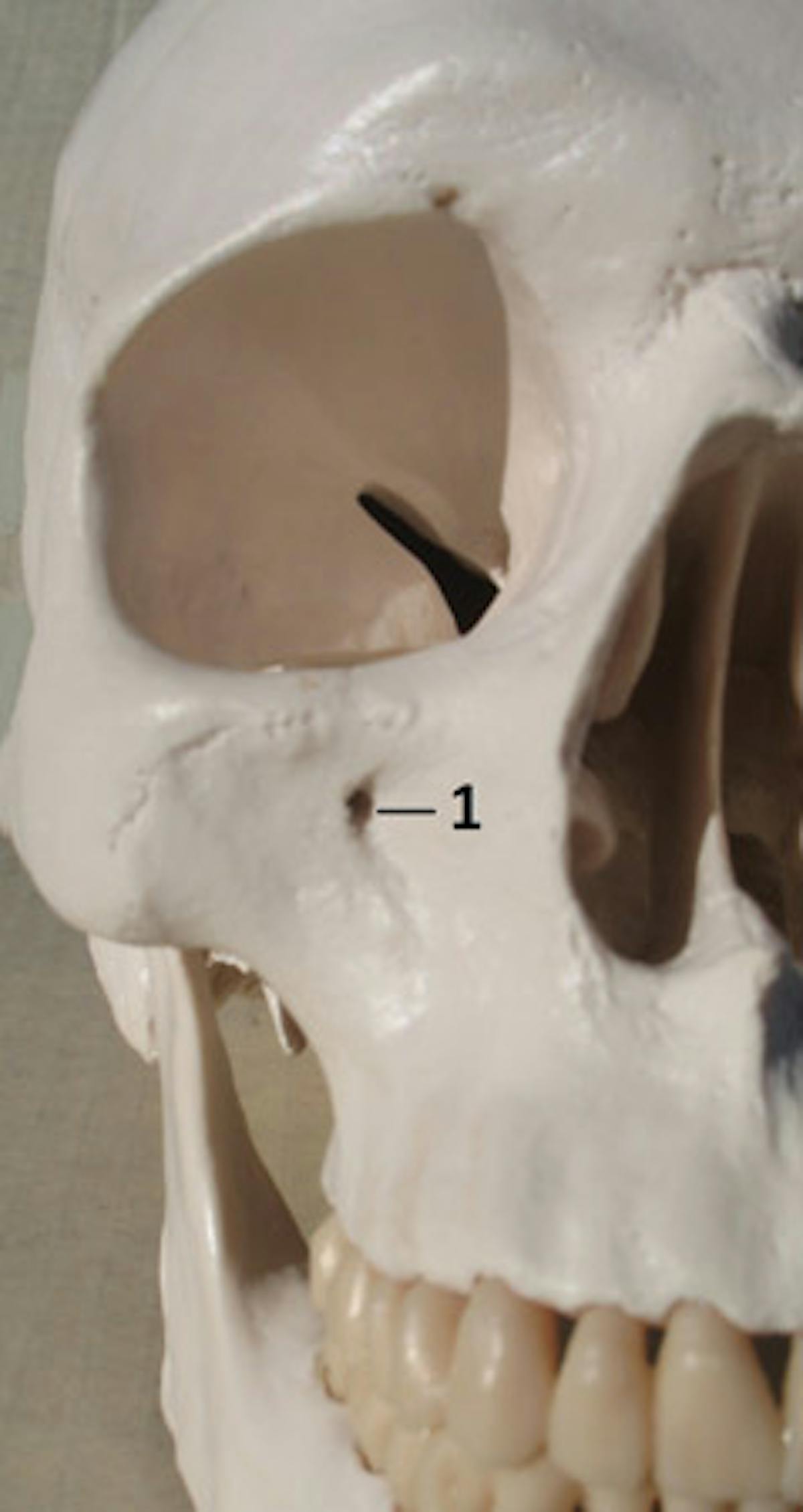 Anesthesia during perio: Maxillary injections useful for adult ...