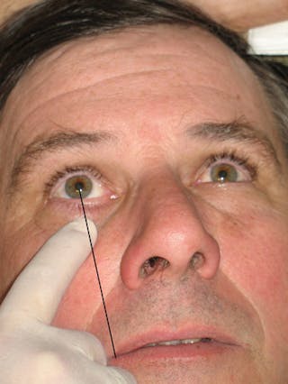 Anesthesia during perio: Maxillary injections useful for adult ...