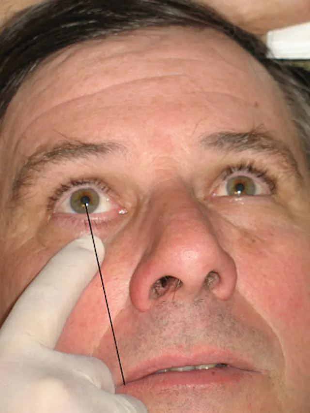 Anesthesia during perio: Maxillary injections useful for adult ...