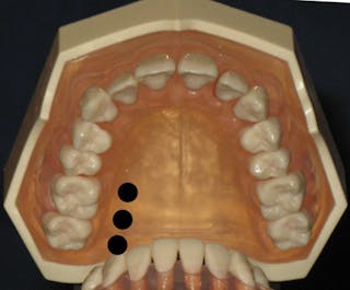 Anesthesia during perio: Maxillary injections useful for adult ...