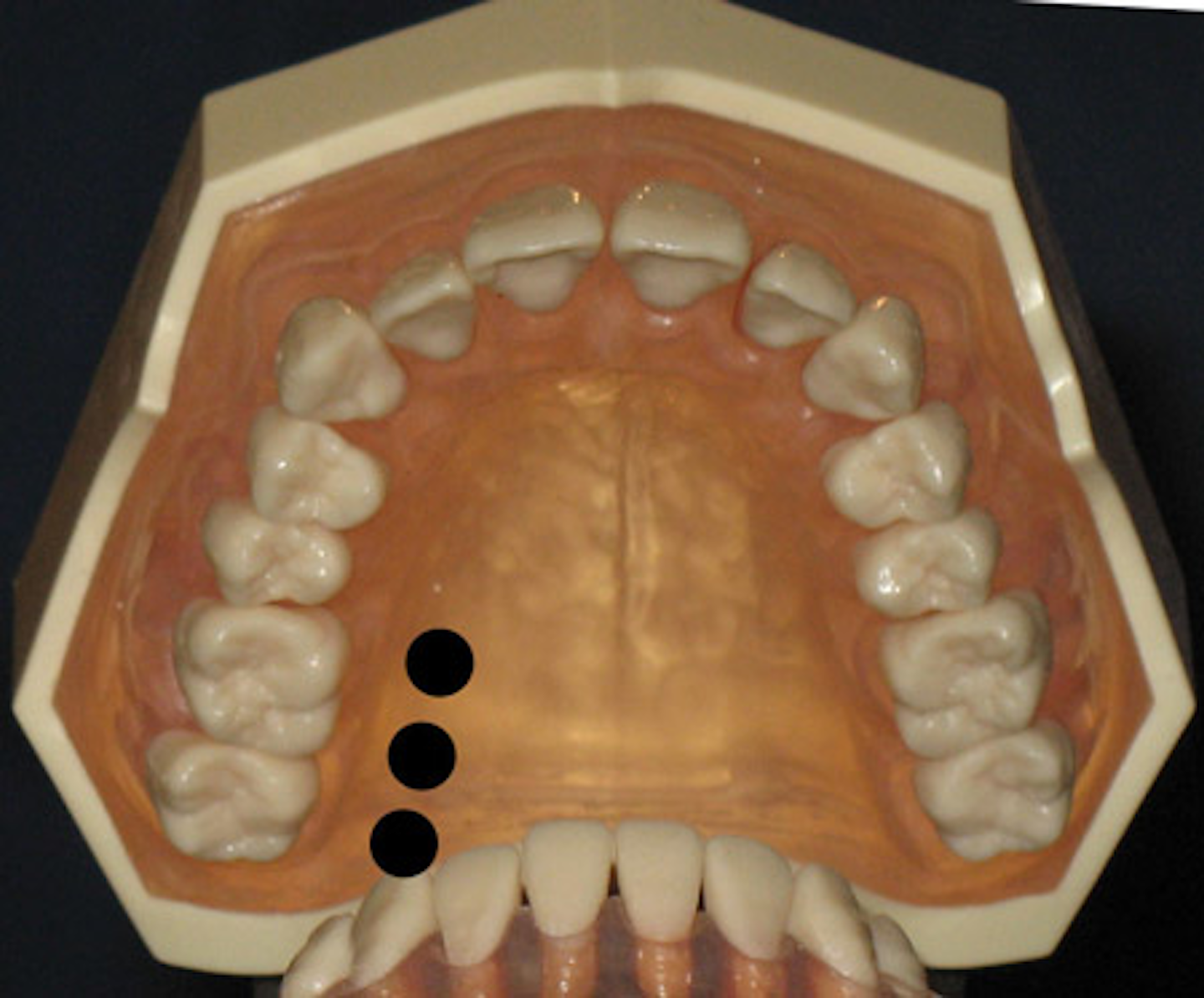 Anesthesia during perio: Maxillary injections useful for adult ...