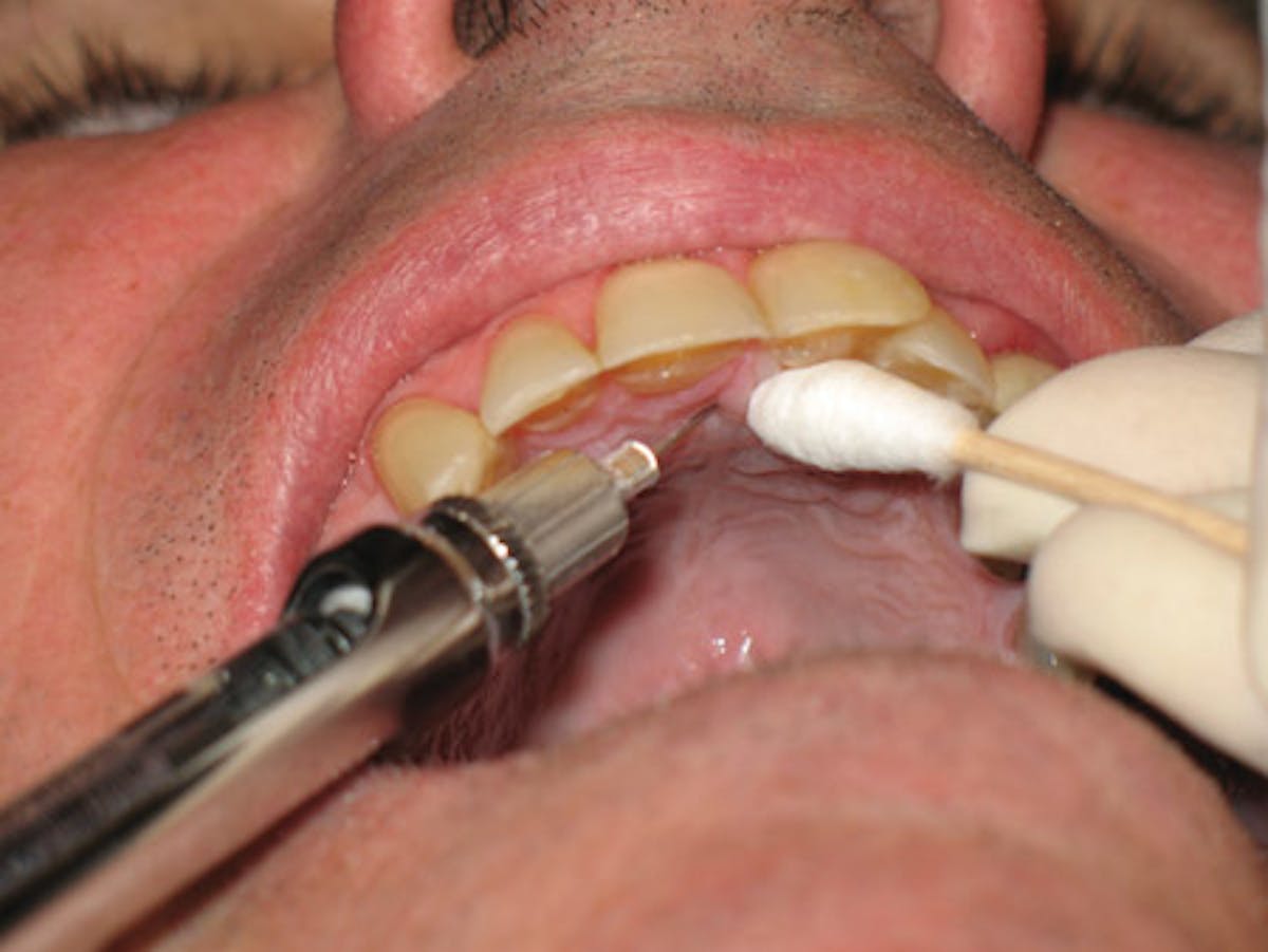 Anesthesia during perio: Maxillary injections useful for adult ...