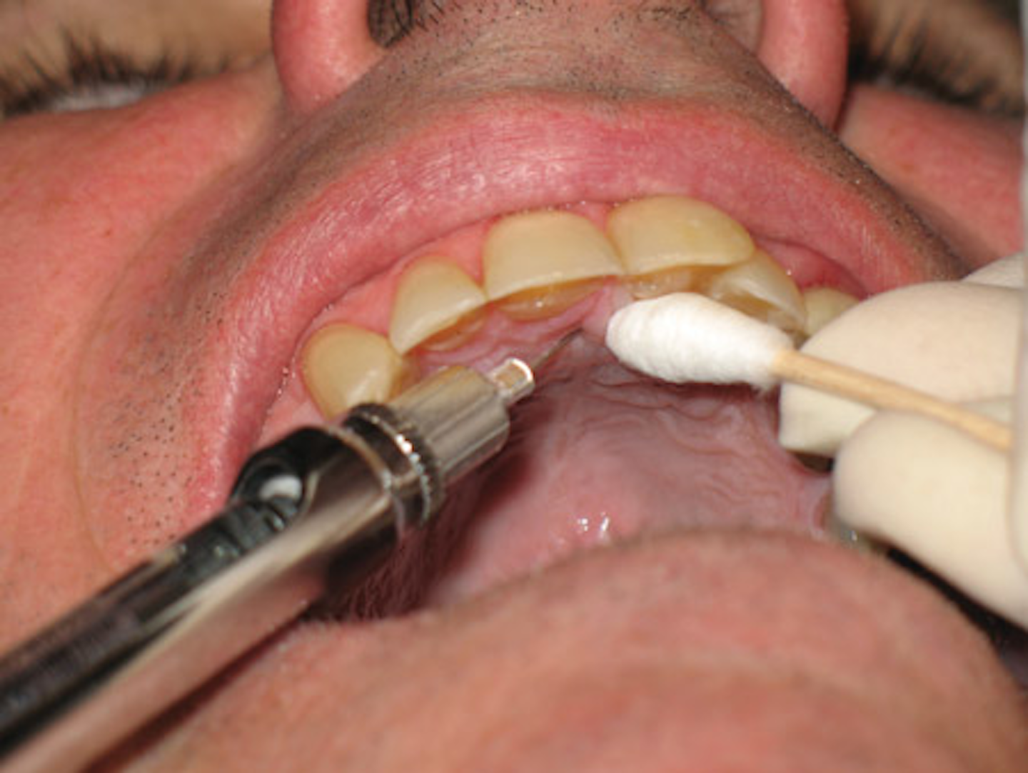 Anesthesia during perio: Maxillary injections useful for adult ...
