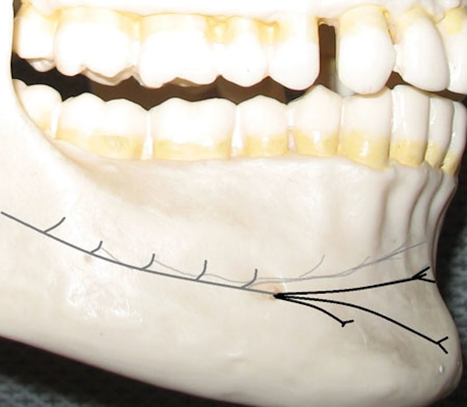 Investigating the incisive block: Procedure minimizes soft tissue ...