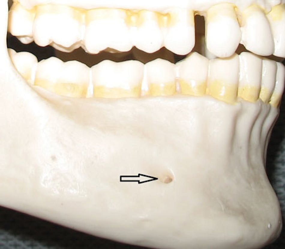 Investigating the incisive block: Procedure minimizes soft tissue ...