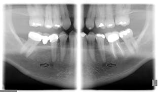 Investigating the incisive block: Procedure minimizes soft tissue ...