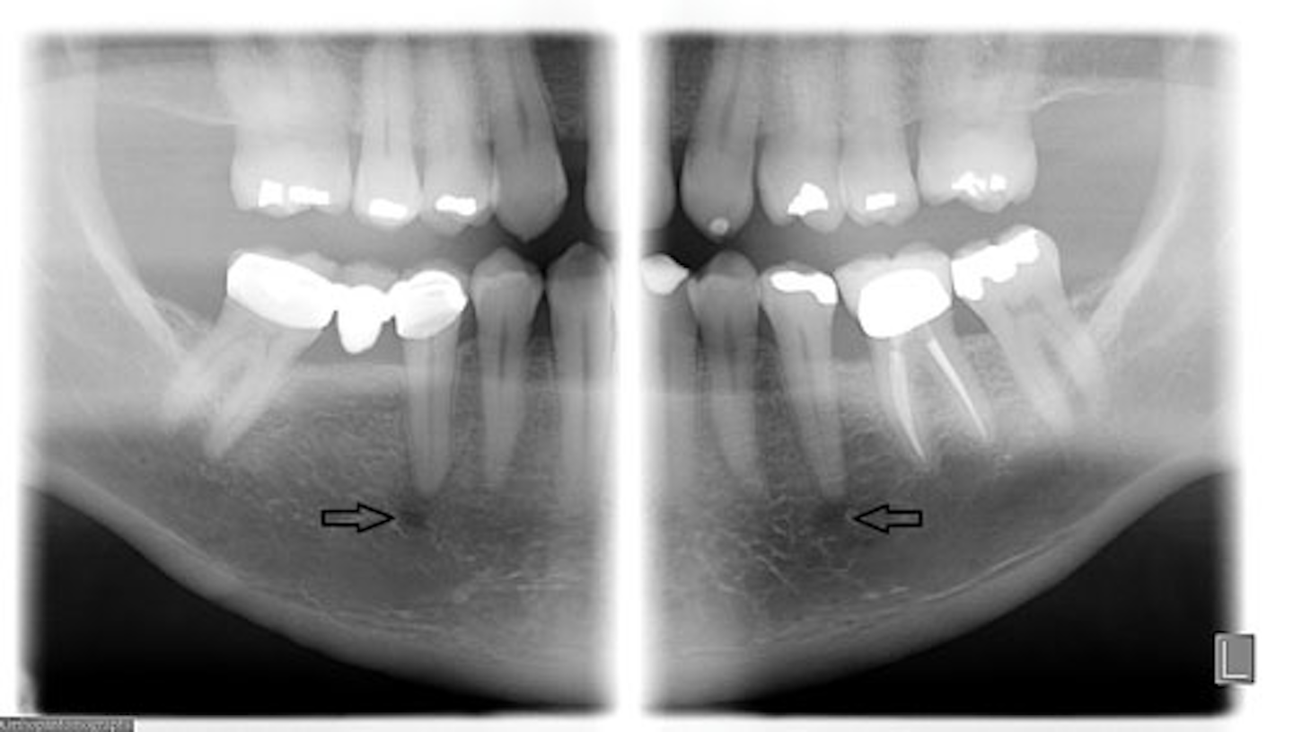 Investigating the incisive block: Procedure minimizes soft tissue ...