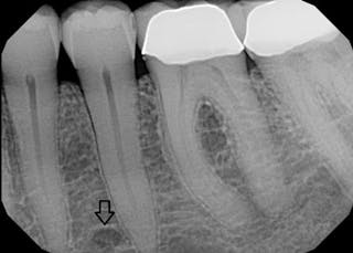 Investigating the incisive block: Procedure minimizes soft tissue ...