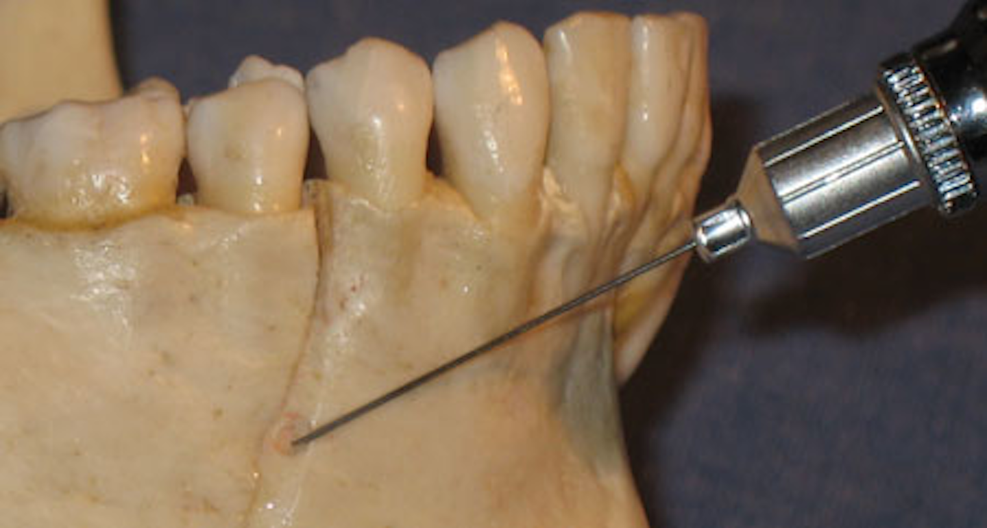 Investigating the incisive block: Procedure minimizes soft tissue ...