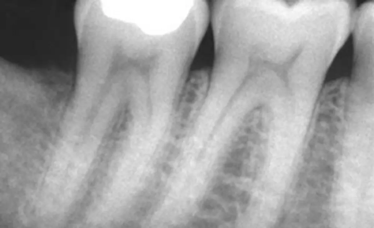 Lingual mandibular sequestration with ulceration | Registered Dental ...