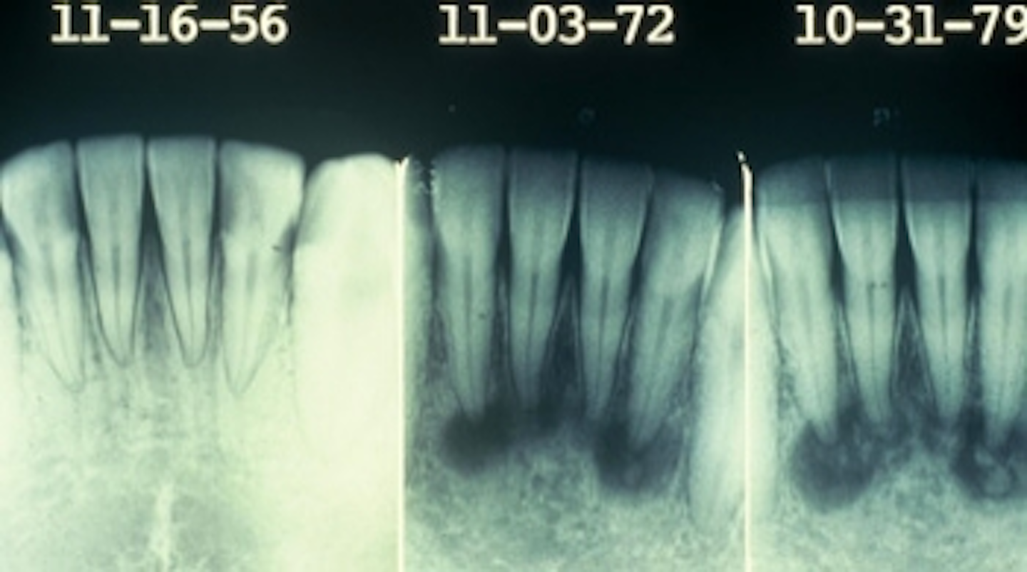 Displasia periapical cemento-ósea | Alai