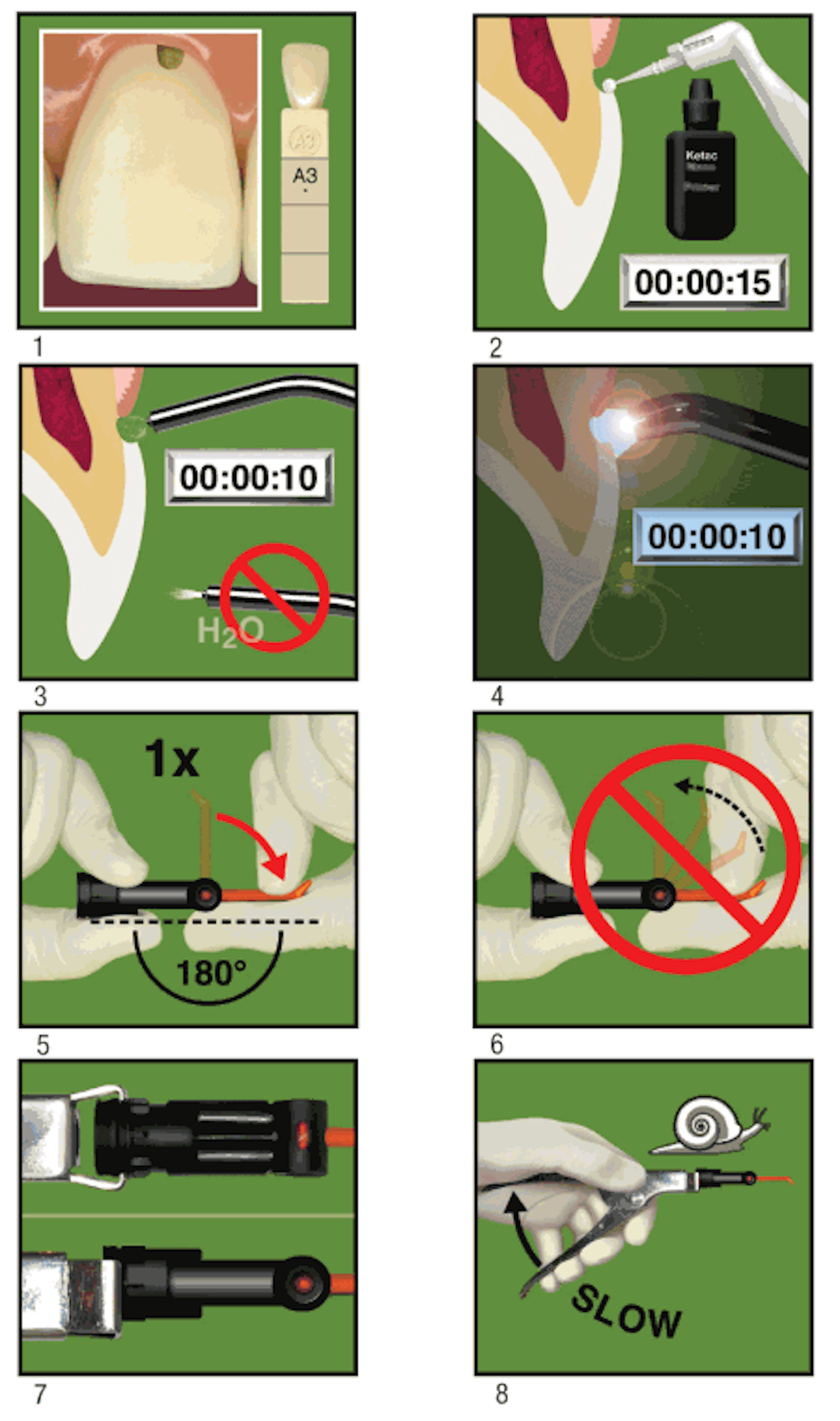 Technique Guide: 3M ESPE's Ketac Nano in the Quick Mix Capsule ...