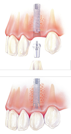 Focus on implant home care | Registered Dental Hygienists