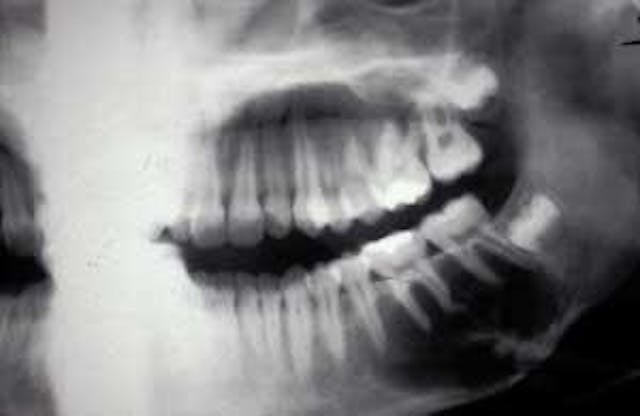 Traumatic Bone Cyst | Registered Dental Hygienists