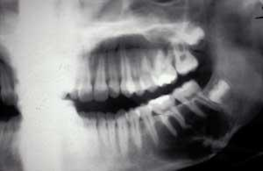 Traumatic Bone Cyst | Registered Dental Hygienists