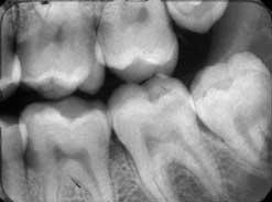 Taking Diagnostic Quality X-Rays | Registered Dental Hygienists