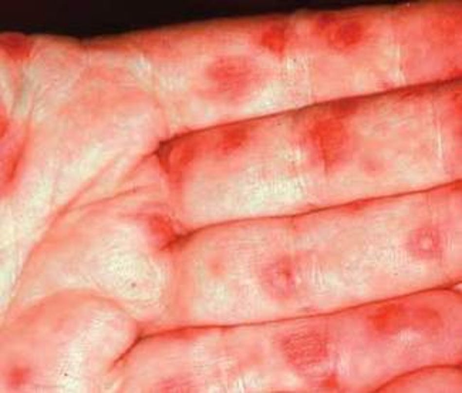 Erythema multiforme | Registered Dental Hygienists