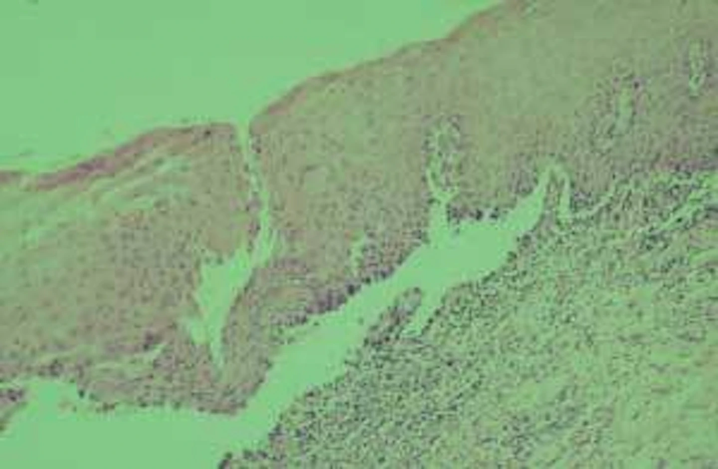 Mucous membrane pemphigoid | Registered Dental Hygienist (RDH) Magazine