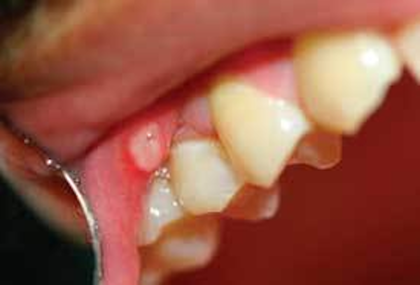 Aphthous ulcers | Registered Dental Hygienist (RDH) Magazine