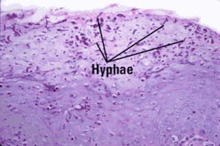 Median rhomboid glossitis | Registered Dental Hygienists