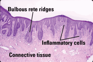 Median rhomboid glossitis | Registered Dental Hygienists
