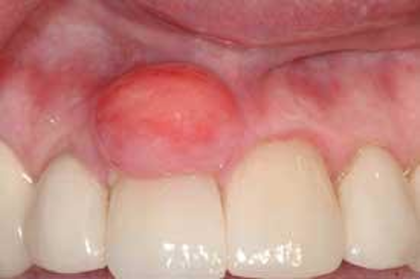 Peripheral Odontogenic Ossifying Fibroma | Registered Dental Hygienists
