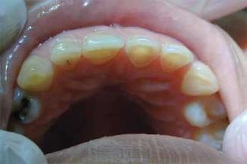 Bulimia | Registered Dental Hygienists