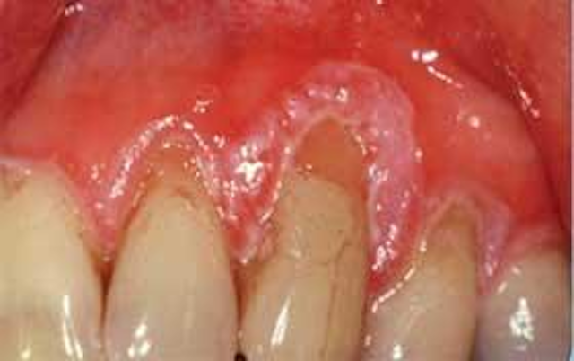 Squamous cell carcinoma | Registered Dental Hygienist (RDH) Magazine