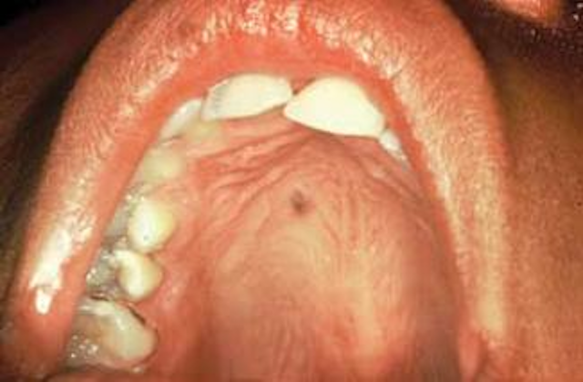 The blue nevus | Registered Dental Hygienist