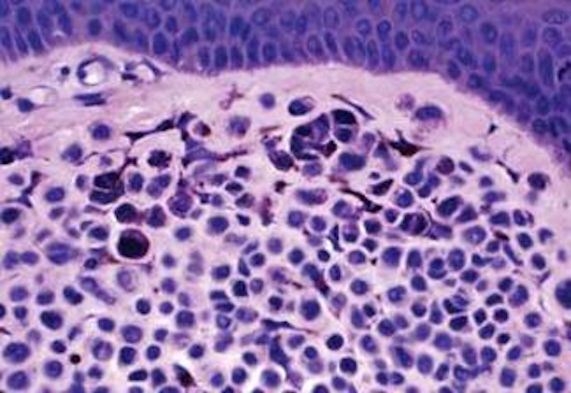 The blue nevus | Registered Dental Hygienist (RDH) Magazine