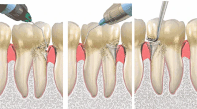 The evolution of analgesia and anesthesia in oral health care ...