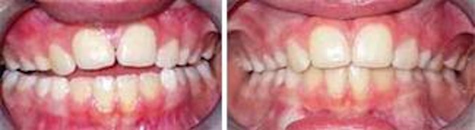 Orofacial myofunctional therapy | Registered Dental Hygienists
