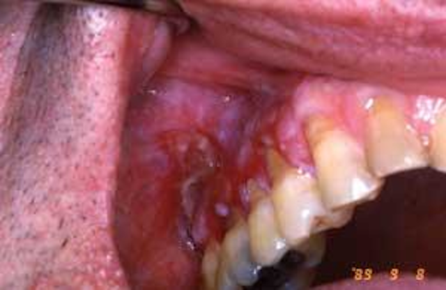 Lichenoid Reactions | Registered Dental Hygienist